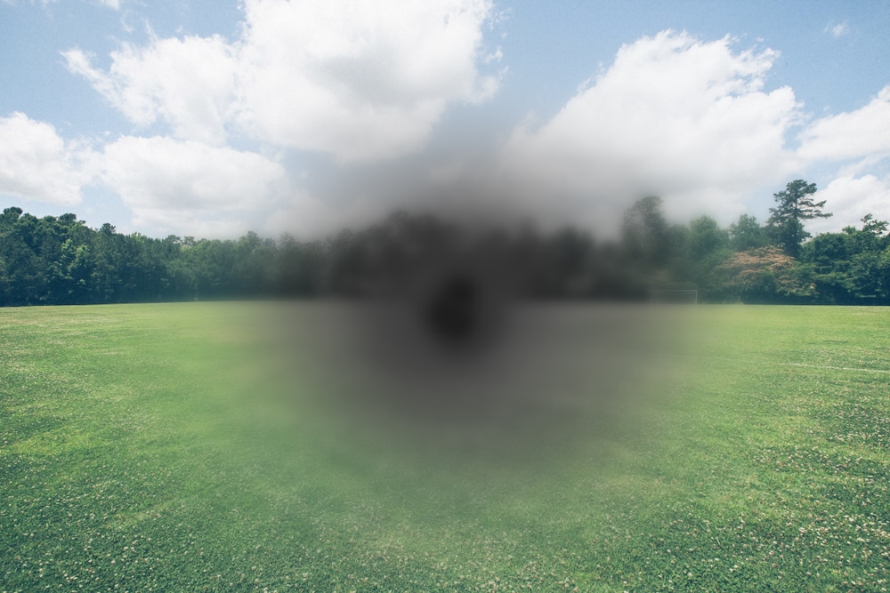 Macular Hole Cincinnati Macular Pucker Florence MidWest Eye Macular Hole Cincinnati Macular Pucker Florence MidWest Eye